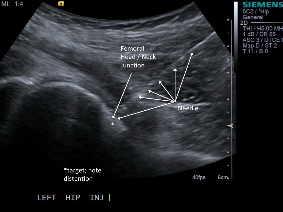 Hip Therapeutic Injection