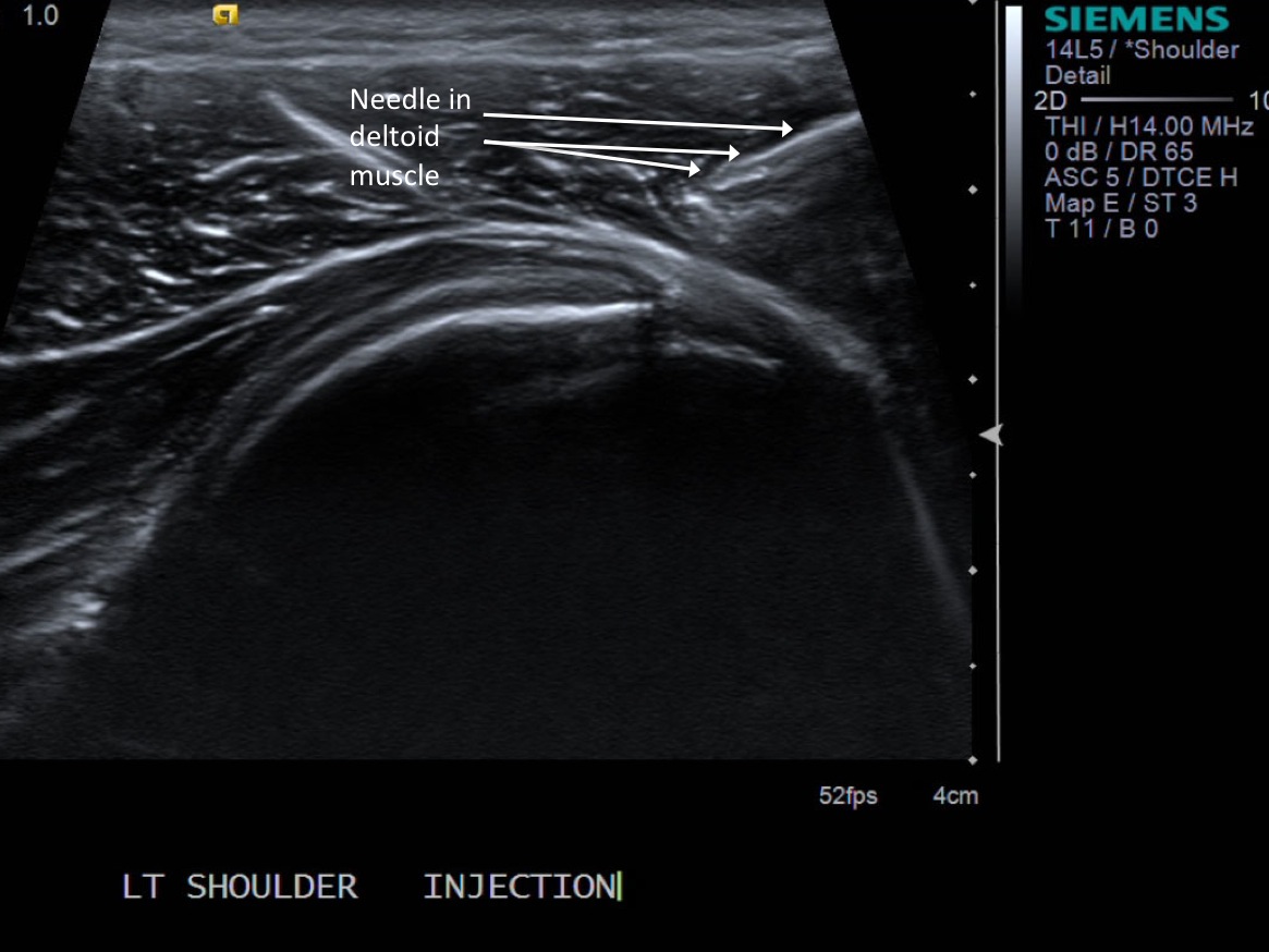 Shoulder Arthrogram Injection