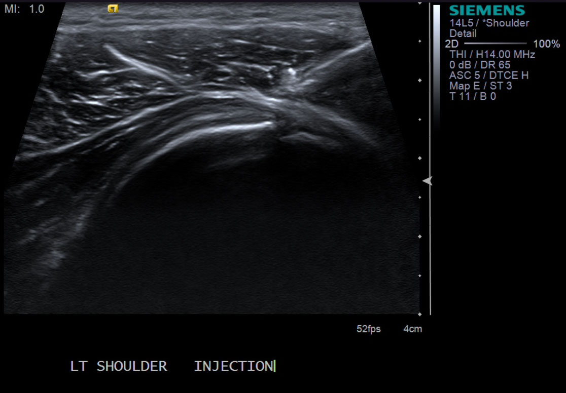 Shoulder Arthrogram Injection