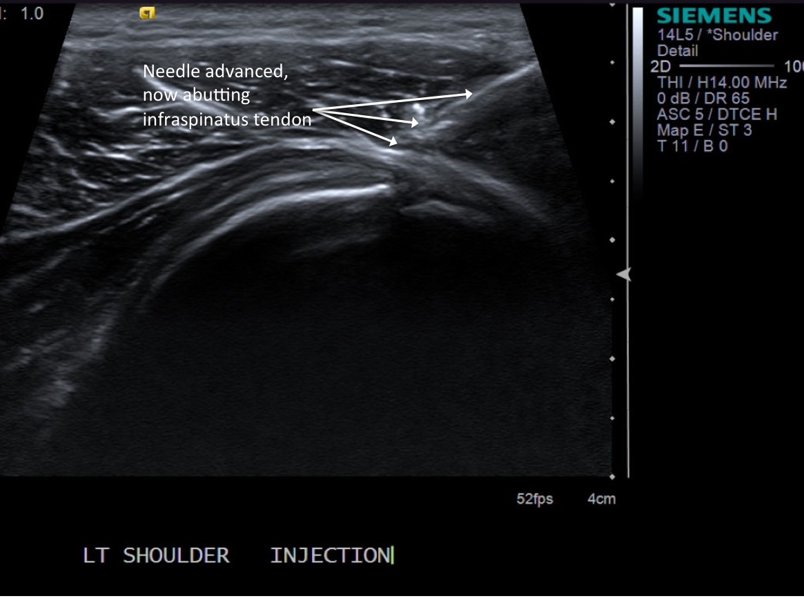 Shoulder Therapeutic Injection