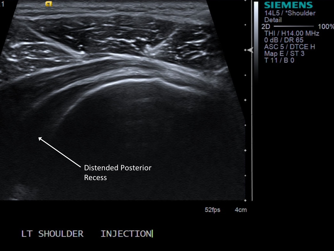 Shoulder Arthrogram Injection