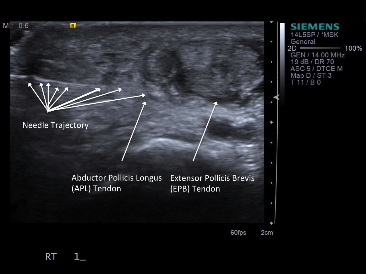 Extensor Pollicis Longus Tendon Test